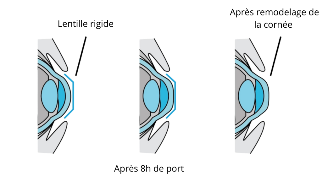 Orthokératologie - Essai Lentilles Montpellier